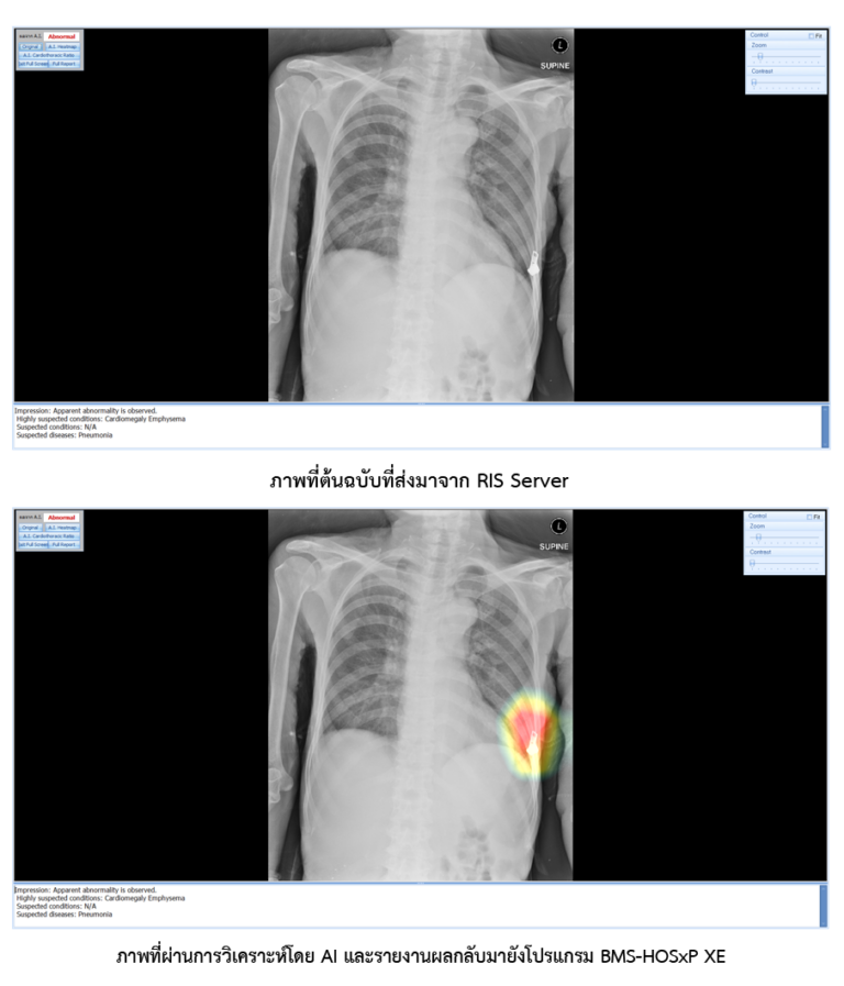 Artificial Intelligence for Radiology : AI – BMS-HOSxP